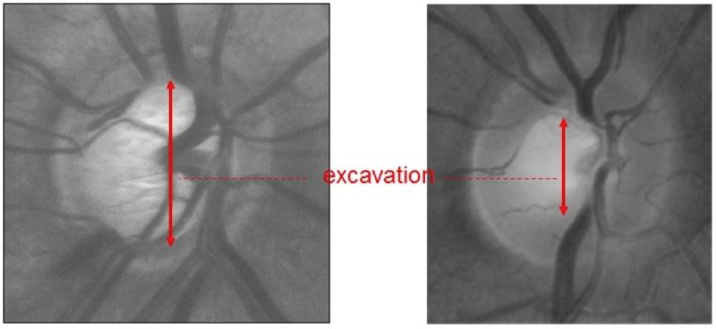 Glaucome - Ophtacenter